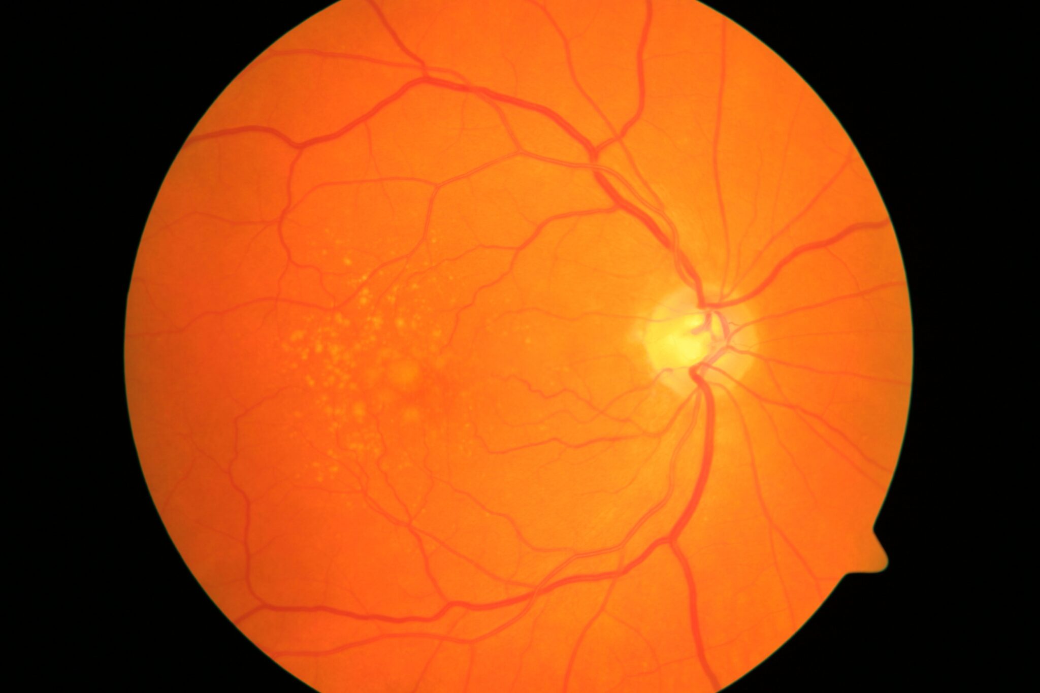 Macular Degeneration – Sunshine Eye Clinic