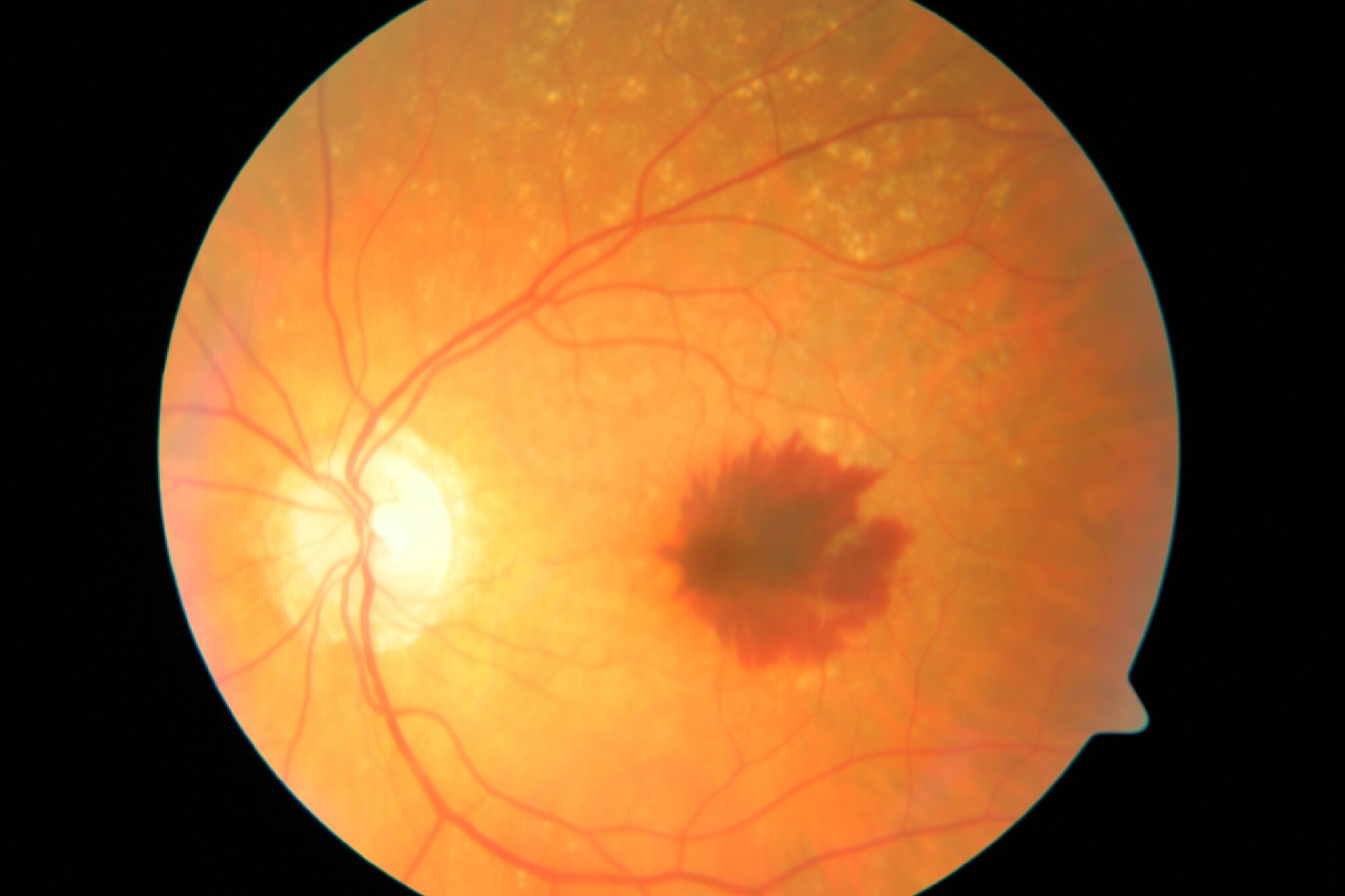 Macular Degeneration – Sunshine Eye Clinic