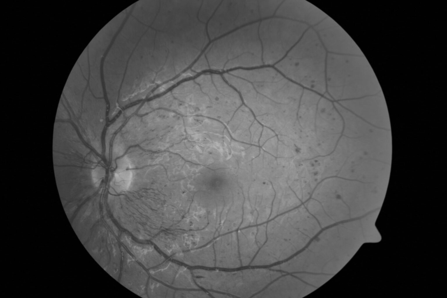 Diabetic Retinopathy Sunshine Eye Clinic